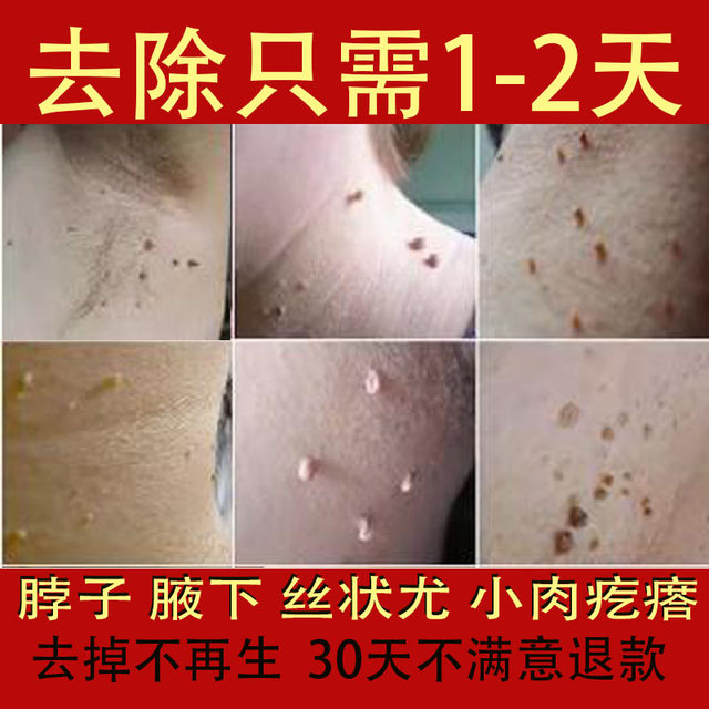 Small meat balls on the neck, meat thorns and pimples, skin, and ...