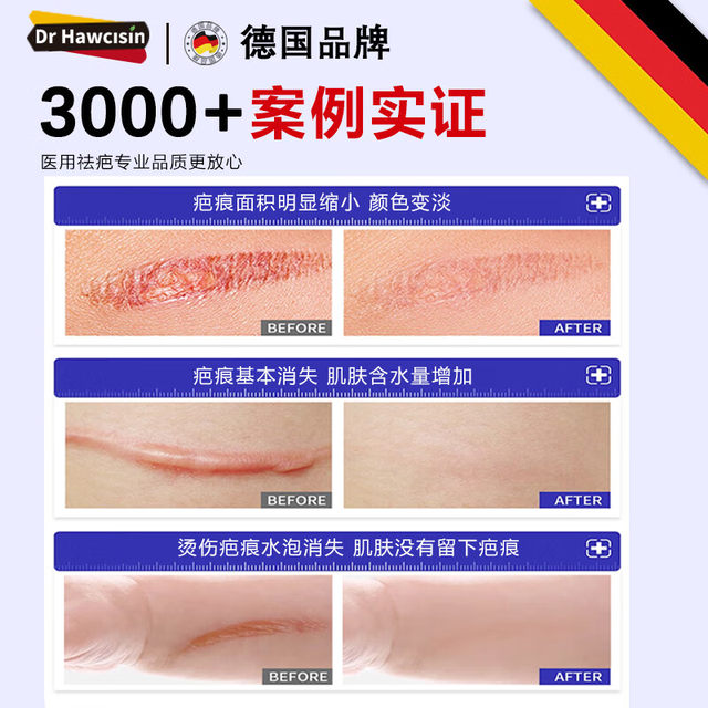 Scar removal cream for medical silicone gel scar removal repair scar ...