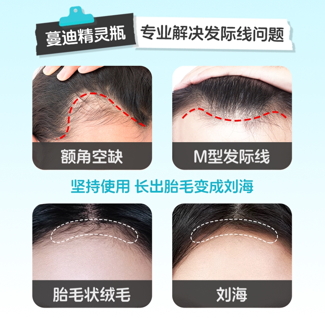 Hairline Exclusive Mandy Hair Growth Elf Bottle Minoxidil Tincture ...