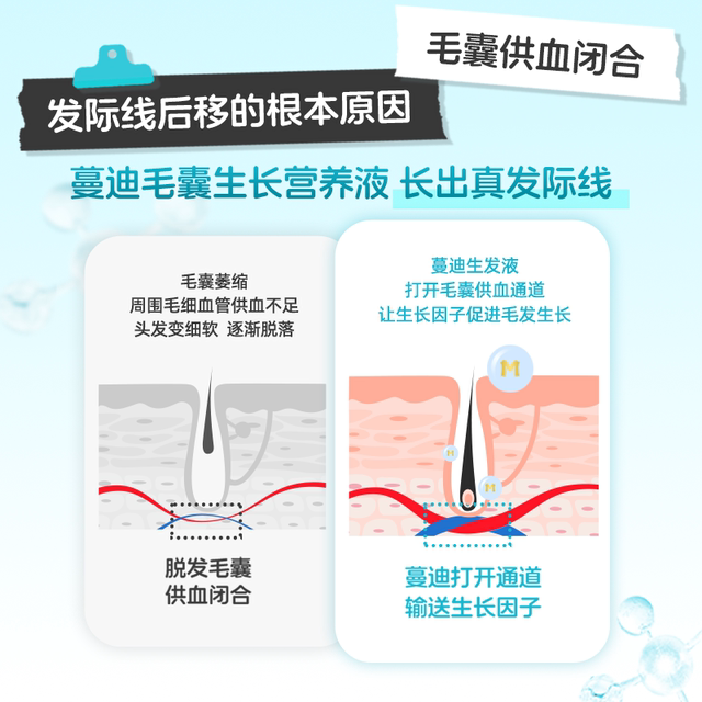 Hairline Exclusive Mandy Hair Growth Elf Bottle Minoxidil Tincture ...