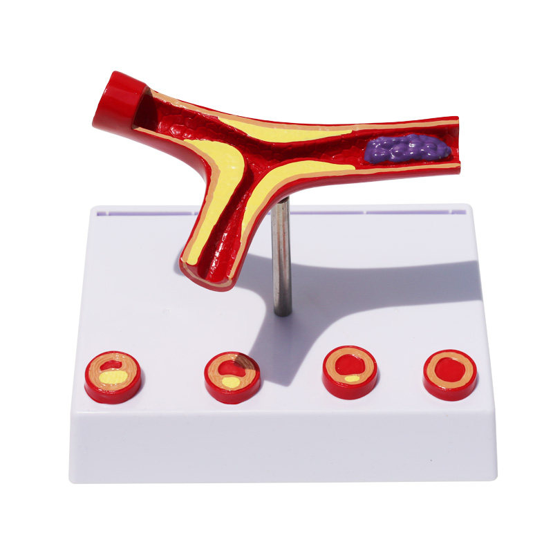 Vascular Pathology Model - Atherosclerosis Thrombosis