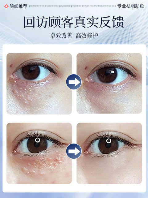 Fat particles removal artifact eye particles clearing eye cream fat ...