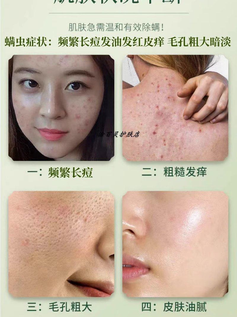 Jiu Xin New Skin Mite Cream - Acne & Pore Treatment