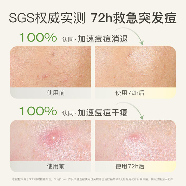 Yuefu Tie Point Acne Essence 6g Quick Shrinking Acne Repair Soothes the ...
