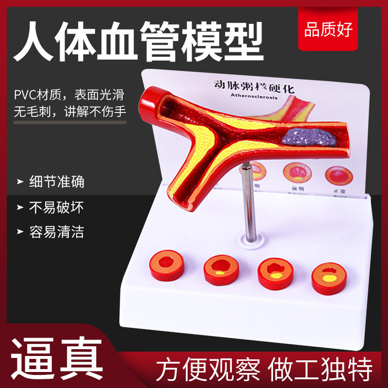 Blood Vessels Arteries Atheroma Sclerosis Pathology Model Thrombus
