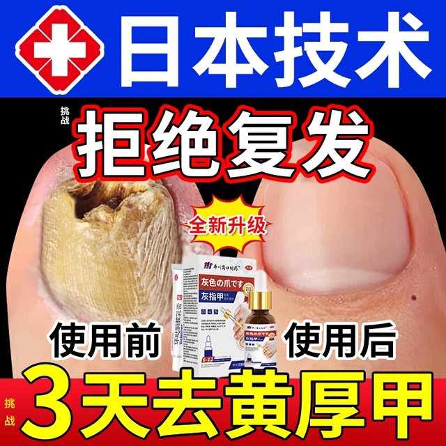 Special potion for treating severe onychomycosis, genuine official ...