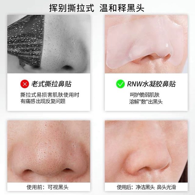 RNW/Ruwei Nose Patch to Remove Blackheads and Closed Acne 10 Tablets 5 ...