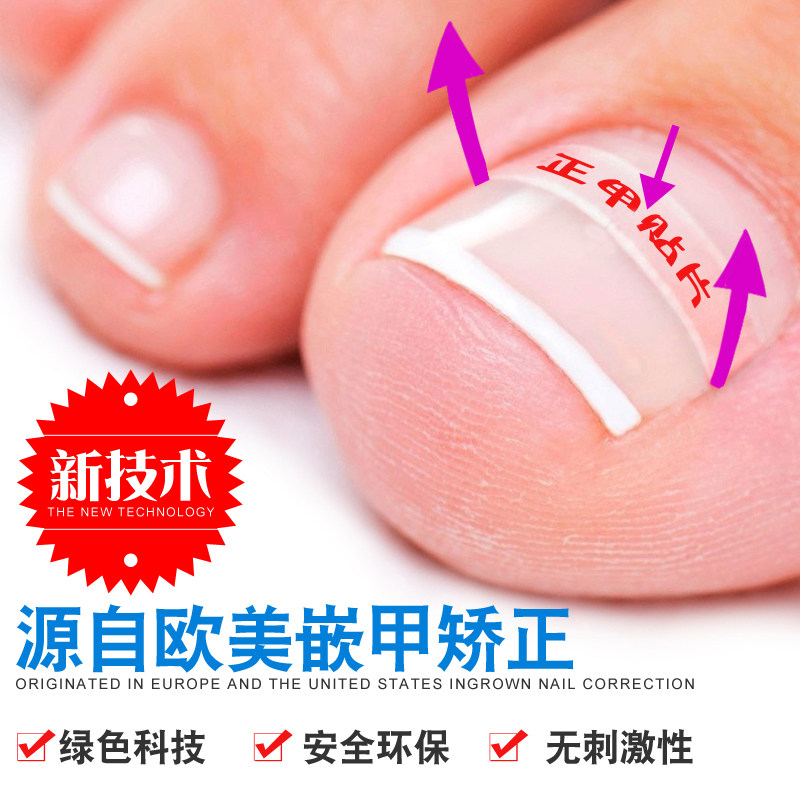 Dispositivo de Corrección de Uñas del Pie Hecai - Alivio para Uñas ...