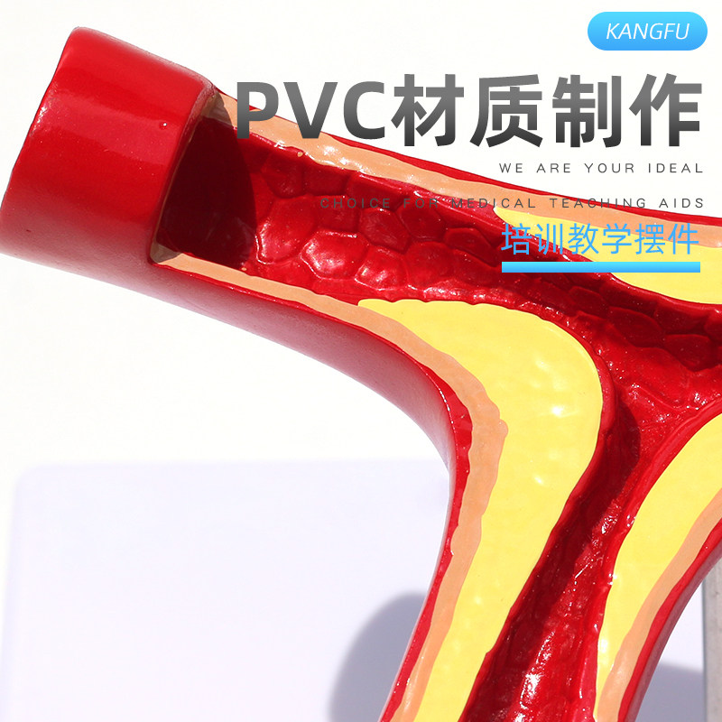 Vascular Pathology Model - Atherosclerosis Thrombosis