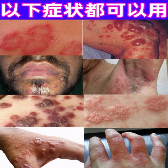 Treatment of AIDS syphilitic virus, herpes virus infection, ulceration ...