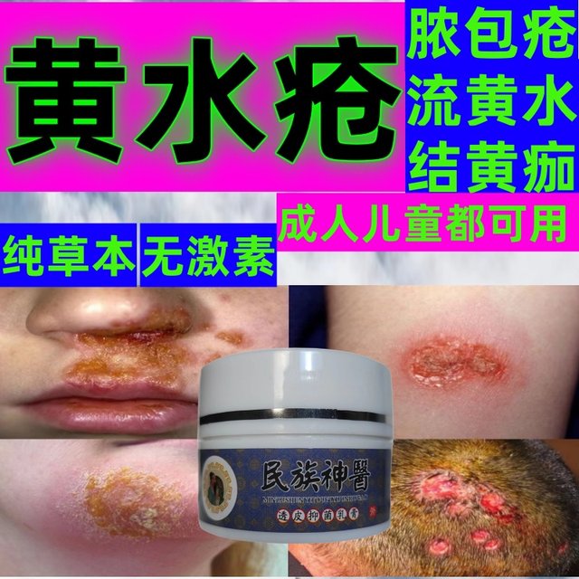 Ointment for treating yellow sores, yellow skin sores, nose ulcers ...