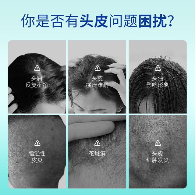 tedol Portuguese ketoconazole lotion anti-dandruff anti-itch selenium ...