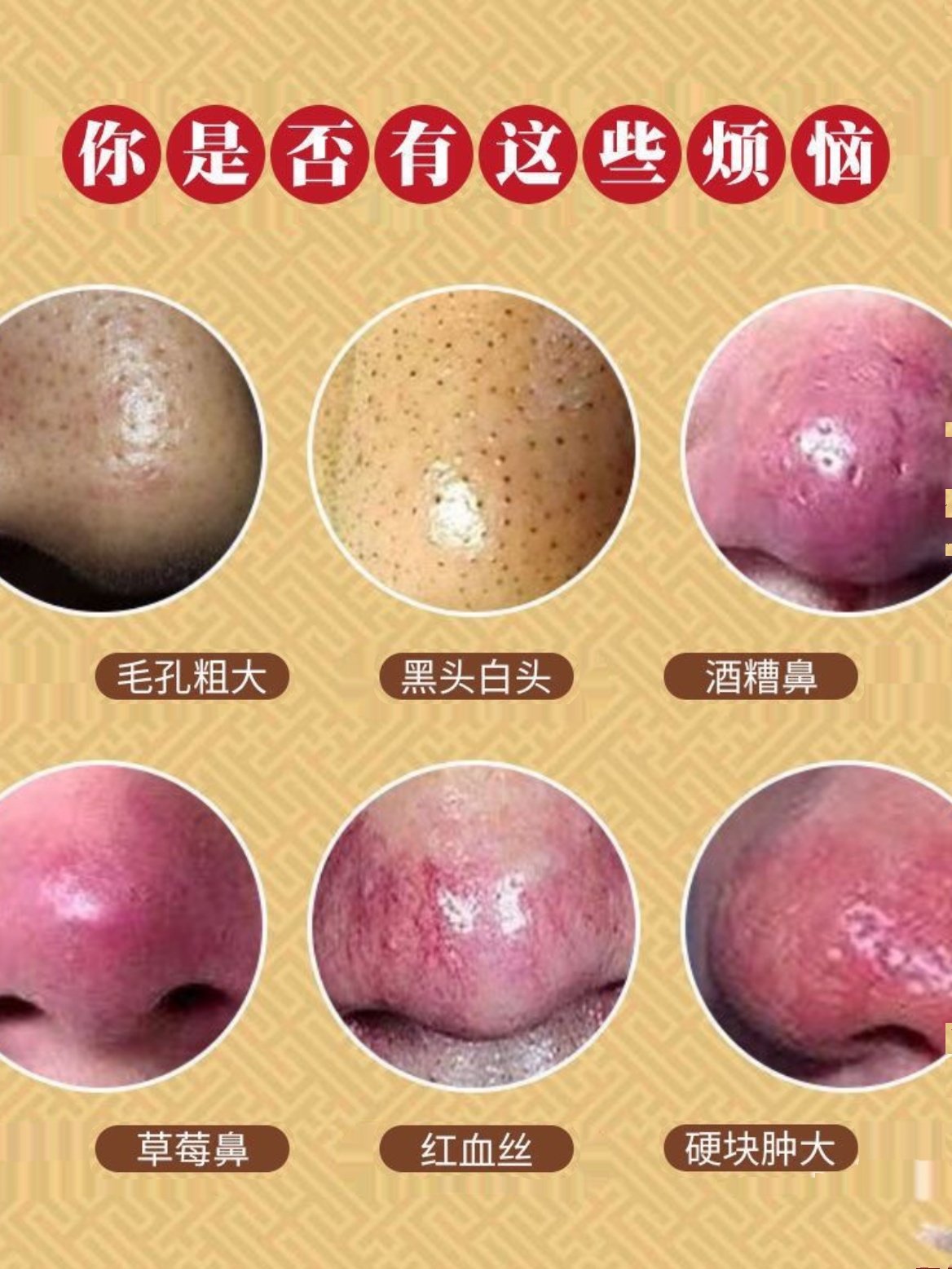 Wenran Huang Fu Tang Rosacea Ointment - 20g - Deep Cleansing & Acne ...