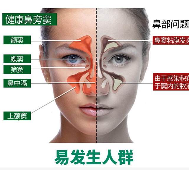 Nose Shuning Snake Bile Composse Enzyme Spray Health Combination Set ...