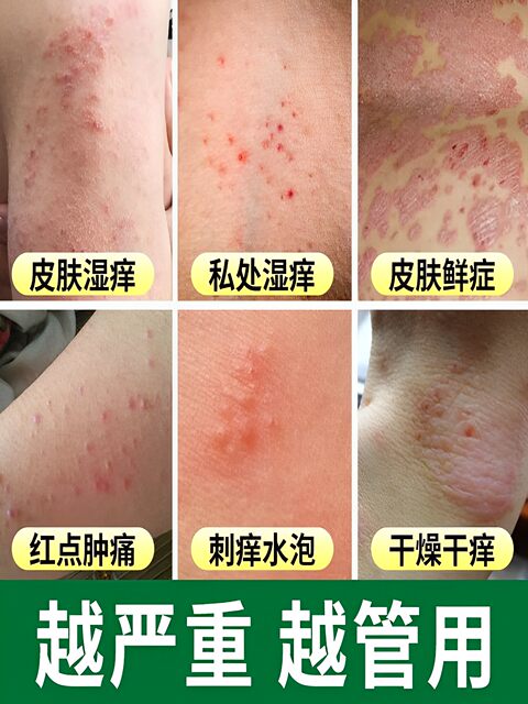 Picangwang old brand anti-itch and anti-bacterial cream for skin ...