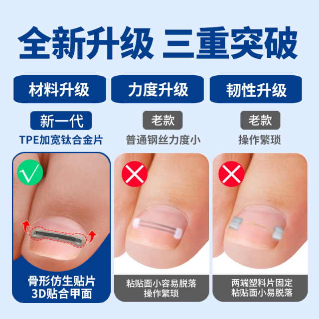 German titanium alloy shrapnel nail groove ingrown toenail corrector ...