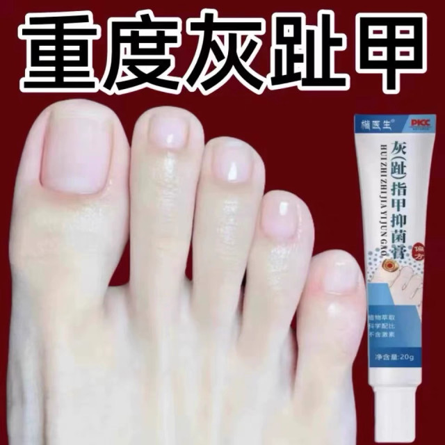 Special medicine for onychomycosis to remove severe nail grooves ...