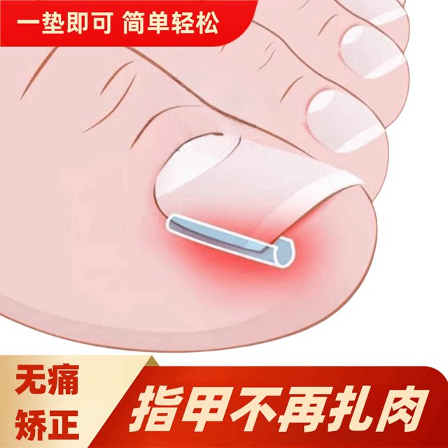 Nail groove corrector, ingrown toenail, special isolation filling pad ...