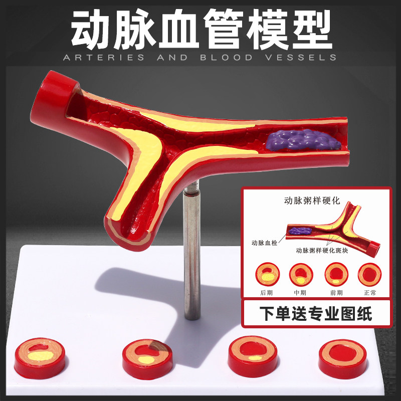 Vascular Pathology Model - Atherosclerosis Thrombosis
