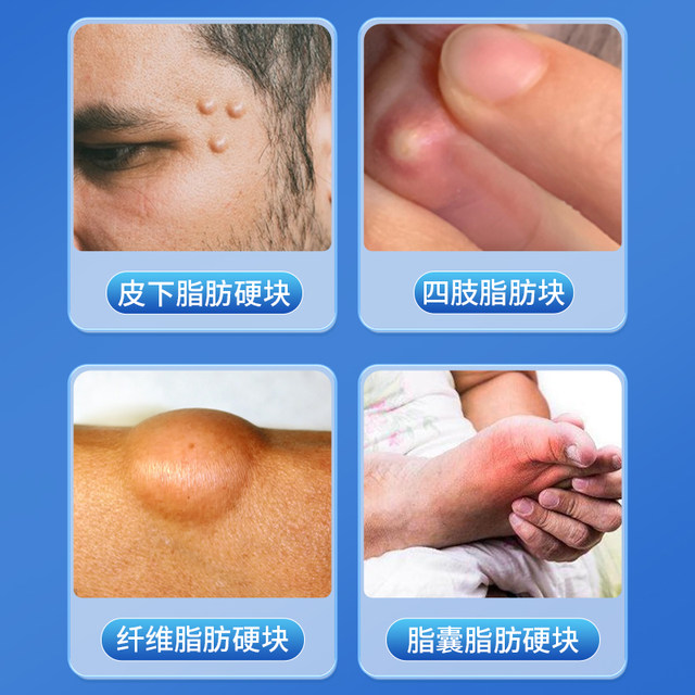 Japan's Jiuyan tumor fat removal sebaceous cyst removal subcutaneous ...