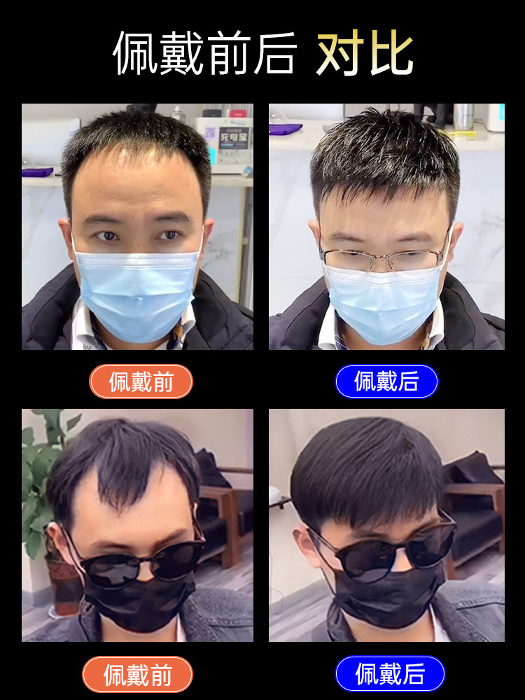 Renus Real Hairline Stickers for Men - Natural Forehead Thinning Coverage
