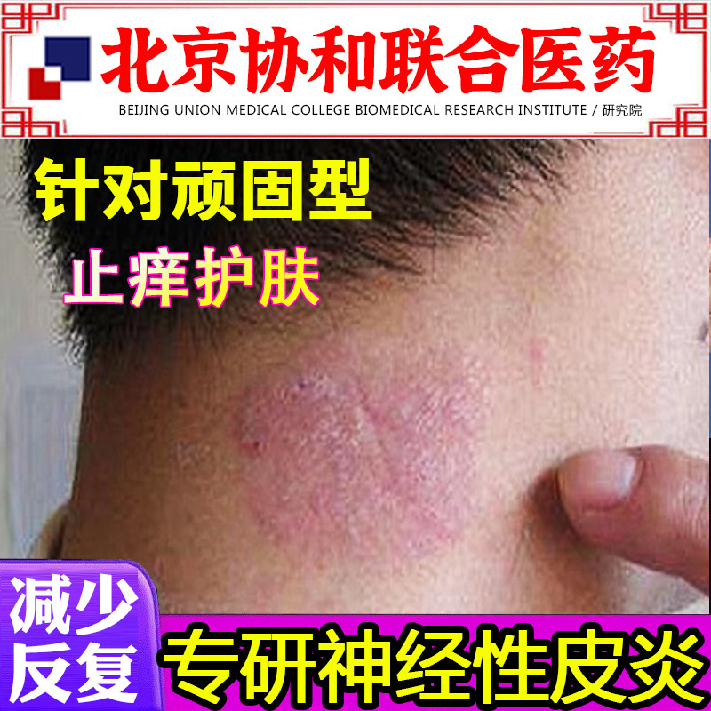 Nevrodermatitt aktuell krem | vanskelig hormonfri behandling for ...